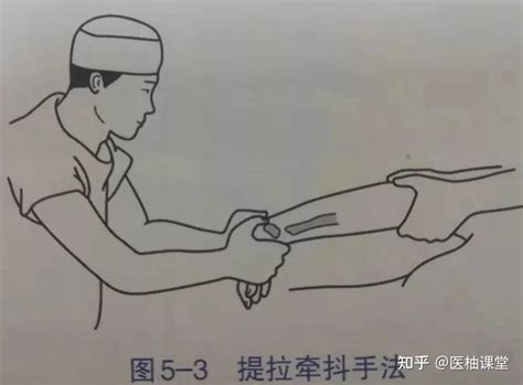 骨折的整复手法全面总结到位 知乎