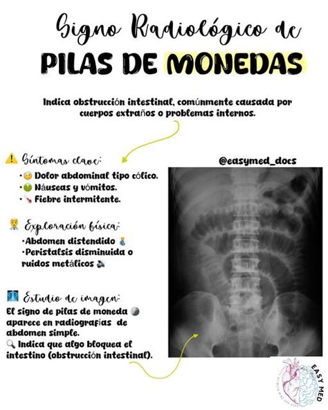 Signos radiológico de pilas de monedas EASY MED Mayelin Peralta