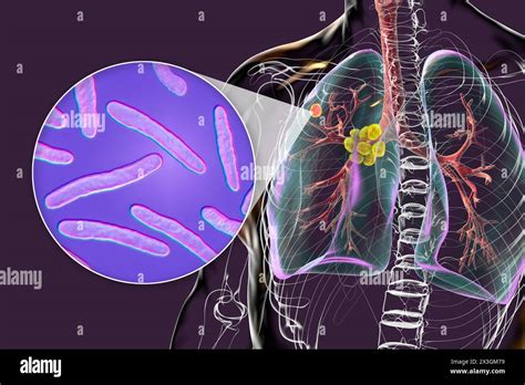 Illustration Of Primary Lung Tuberculosis Featuring The Ghon Complex And Mediastinal