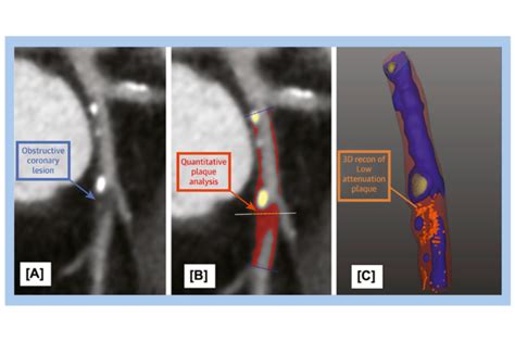Plaque Burden And 1 Year Outcomes In Acute Chest Pain Translational