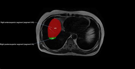 Mri Liver Anatomy Axial Segments And Lobes Labeled