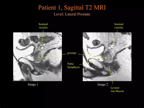 Prostate Mri Anatomy From University Of Michigan Ppt