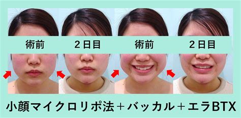 ダウンタイムの短い「小顔組み合わせ治療」 Womクリニック銀座