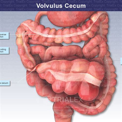 Volvulus Cecum