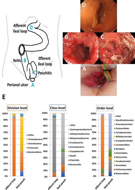 How Do You Treat This Diversion Ileitis And Pouchitis Gut