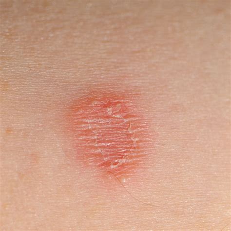 Circular Rashes That Arent Ringworm According To Doctors