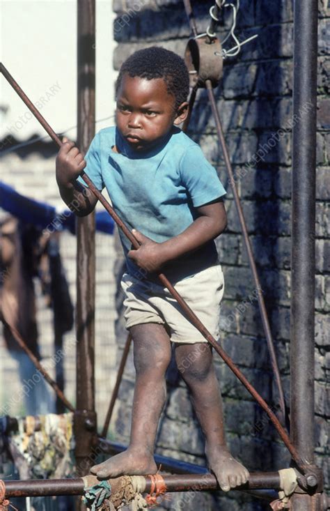 Boy With Rickets Stock Image C0034404 Science Photo Library