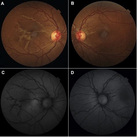 Angioid Streaks