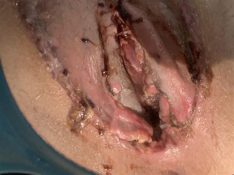 Immediate And 1 Week Post Operative Mtf Sex Reassignment Rnsfl