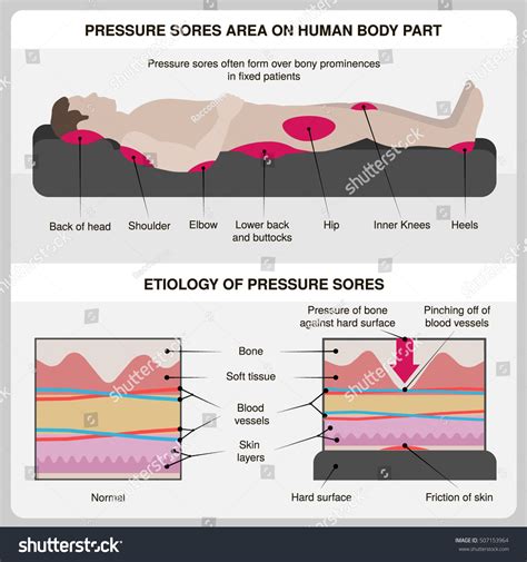 Man Pressure Sores Pressure Sores Area Stock Vector Royalty Free