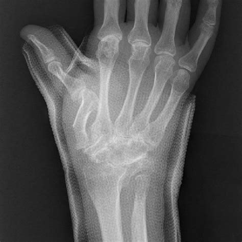 Status After Eip To Epl Tendon Transfer Note The Mcp Dorsal