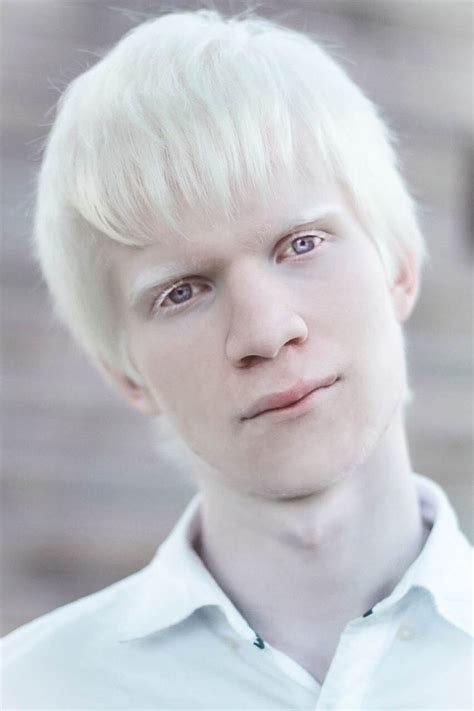 Albino Nedir Albino Hastalığı Nedir Nedenleri Nelerdir BİLGİLİ USTA