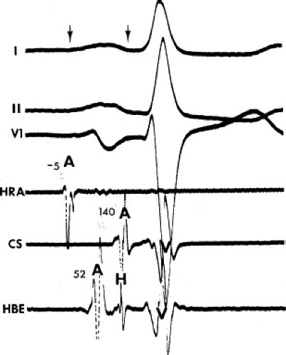 Atrioventricular Conduction Thoracic Key