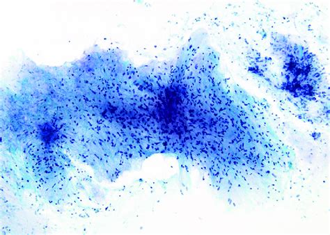 Mpnst A Moderately Cellular Cell Syncytial Aggregate Contains