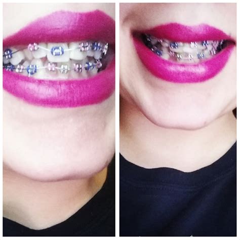 I Got Braces The Other Day It Feels A Bit Weird Being 24 With Them