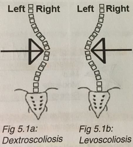 Scoliosis And Short Leg Syndrome Flashcards Quizlet