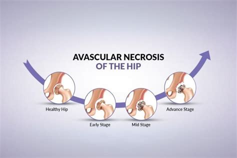 Avascular Necrosis Of Hip My Blog