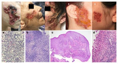 Lesions 1 5 And Histopathology A D Of Granulomatous Pyoderma