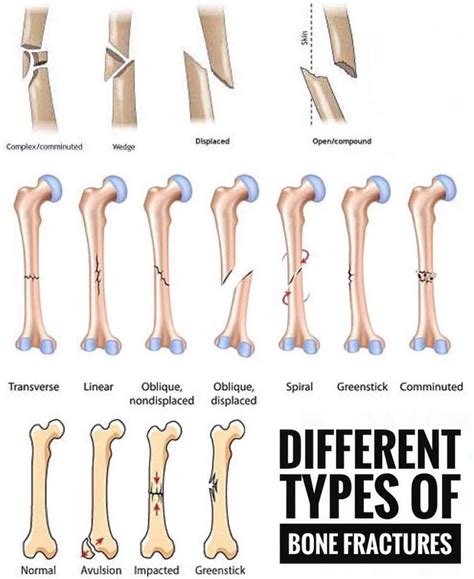 Serrated Fracture Definition