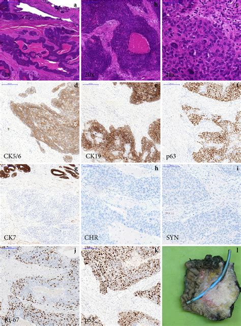 The Tumor Cells Formed Nests With Basaloid Morphology Surround Ing Download Scientific Diagram
