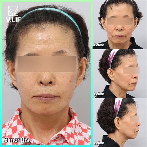 Vlif Facelift Plastic Surgery Plastic Surgery Korea Facelift Before