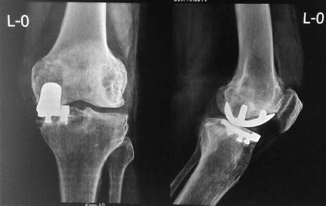 At 2 Years Of Follow Up Anteroposterior And Lateral Radiographs Of