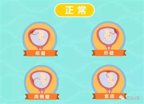 想順產你的胎盤位置正常嗎胎盤前置就只能剖腹產了麼 每日頭條