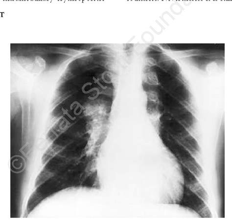 Figure 1 From Extramedullary Bone Marrow Tumor In Thalassemia