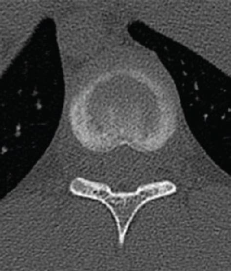 Magnetic Resonance Imaging Before Myelography A And Computed Download Scientific Diagram