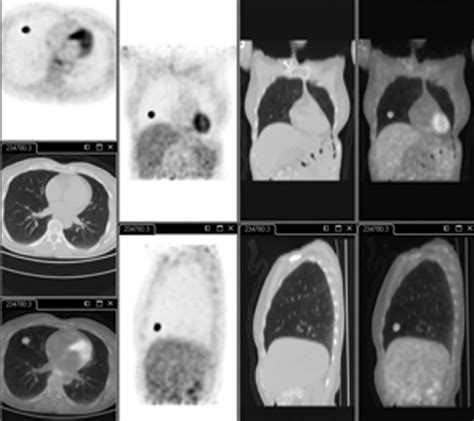 F‑18 Fdg Petct Scan Transaxial‑ Coronal‑ And Sagittal‑section