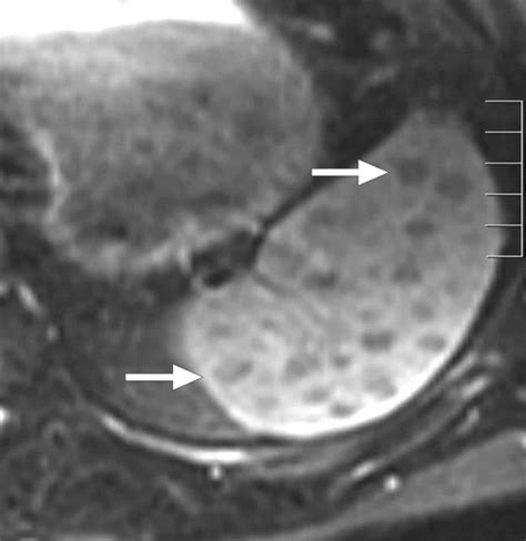 Cross Sectional Imaging Findings Of Splenic Infections Is Differential