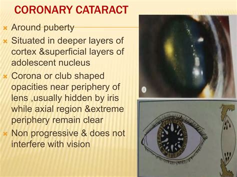 Pediatric Cataract Pptx