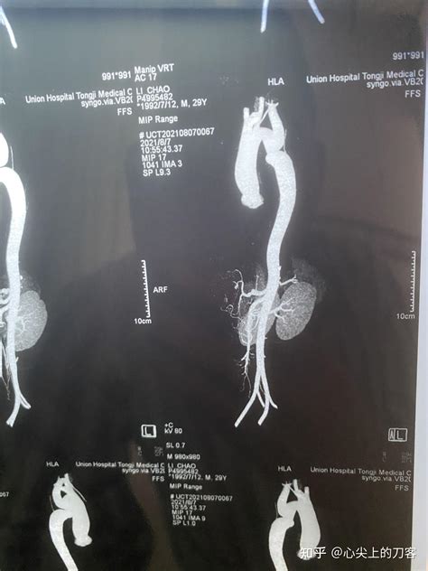 主动脉缩窄 知乎