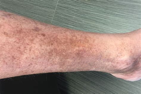 Symptoms Of Venous Stasis Dermatitis Pictures Symptoms And Pictures