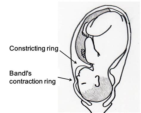What Is Retraction Uterus At Rose Hui Blog