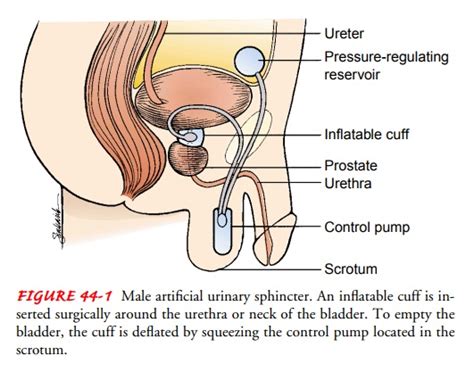 Urinary Incontinence Dysfunctional Voiding Patterns