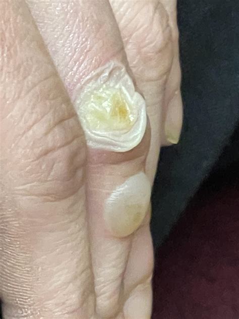 Spider Bites Rspiderbites