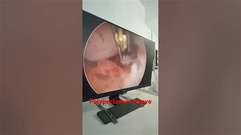 Polypectomy Remove In Hysteroscopy Surgery Operationtheatretechnician
