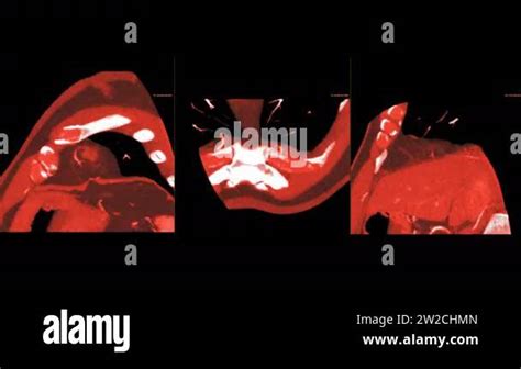 Aortic Mitral Valve Stock Videos And Footage Hd And 4k Video Clips Alamy