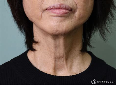 【60代女性・首の縦筋】ネフェルティティリフト（4ヶ月後） 症例写真 美容整形、美容外科なら聖心美容クリニック