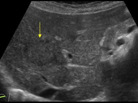 Abdomen And Retroperitoneum 11 Liver Case 119 Metastases