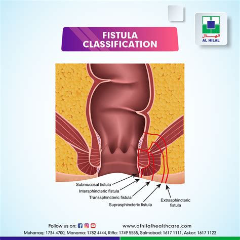 Anorectal Fistula Classification