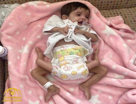 إنفاذًا لتوجيهات خادم الحرمين عملية فصل التوأم الطفيلي اليمني عائشة