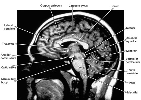 Anatomy Mri Brain