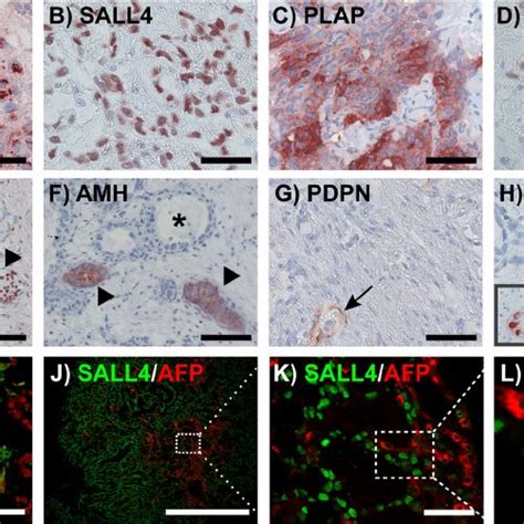 Immunohistochemical Protein Marker Analysis Of Paediatric Teratoma