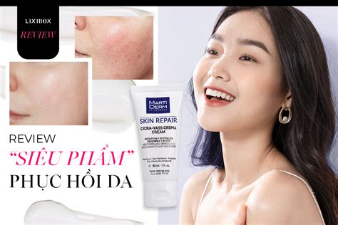 Sau Khi Nặn Mụn Nên Bôi Gì để Da Không Sưng Tấy Và Thâm Sẹo Gái Xinh