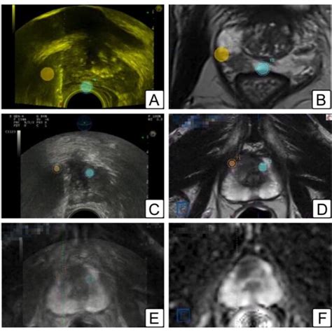 Illustrations Of Mritrus Fusion Biopsy Ab Peripheral Zone Target