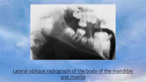 Mandible Lateral Oblique