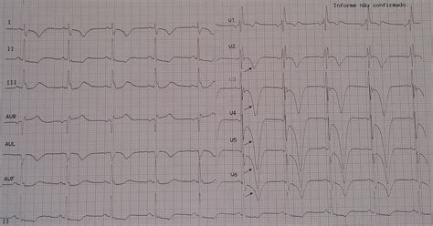 Wellens Syndrome A Pattern To Remember Bmj Case Reports