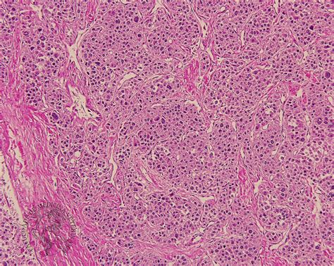 Chemodectoma Of The Aortic Body Dog